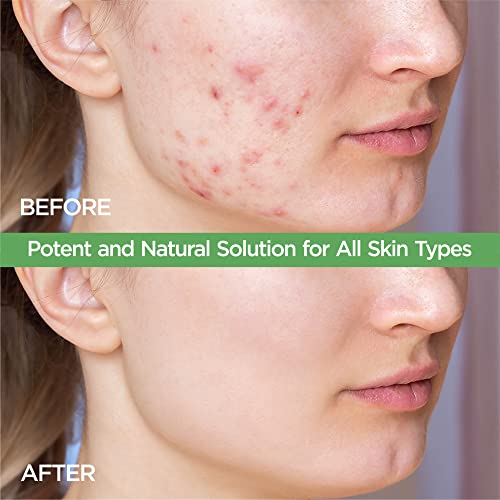 blended supplements for acne relief