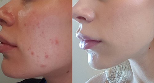 blended vitamin supplements for acne relief
