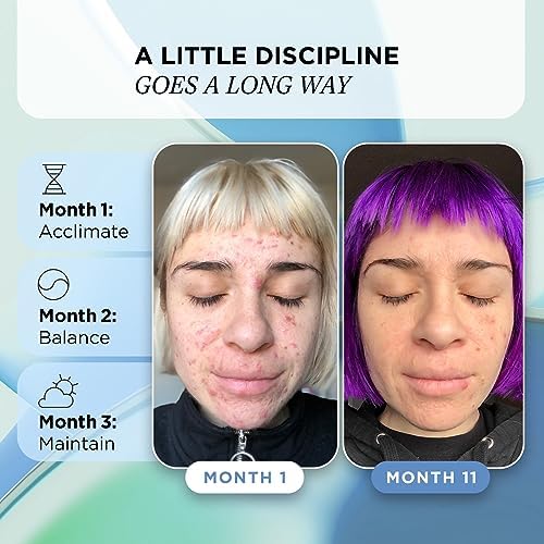 cystic acne relief supplements for women