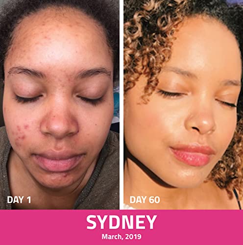 cystic acne treatment vitamin blend