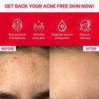 Daily acne supplement for glowing complexion