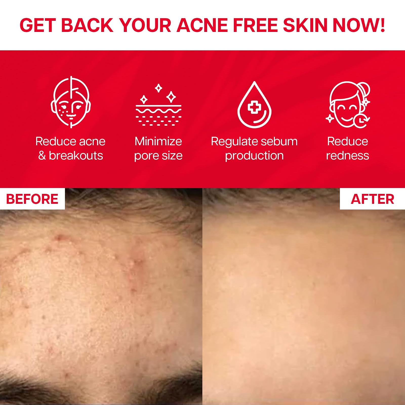 Daily acne supplement for glowing complexion