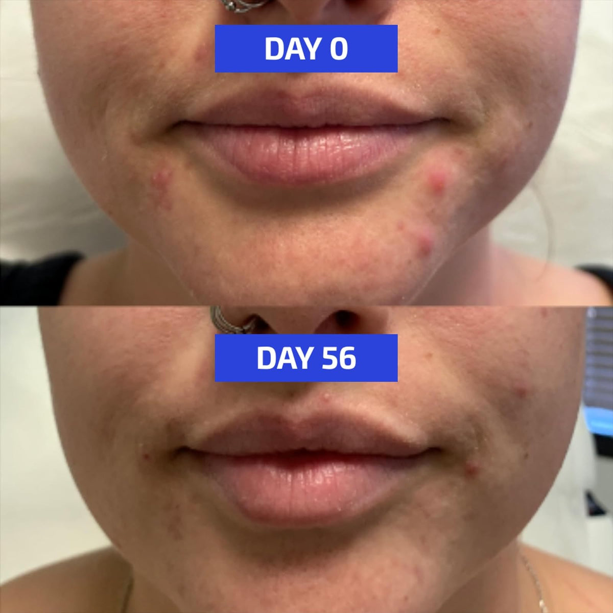 Daily capsules for clearer skin