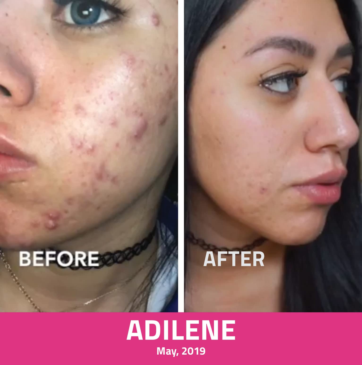 daily supplement for clearer complexion