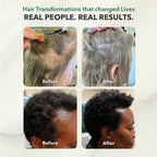 DHT reduction for thicker hair