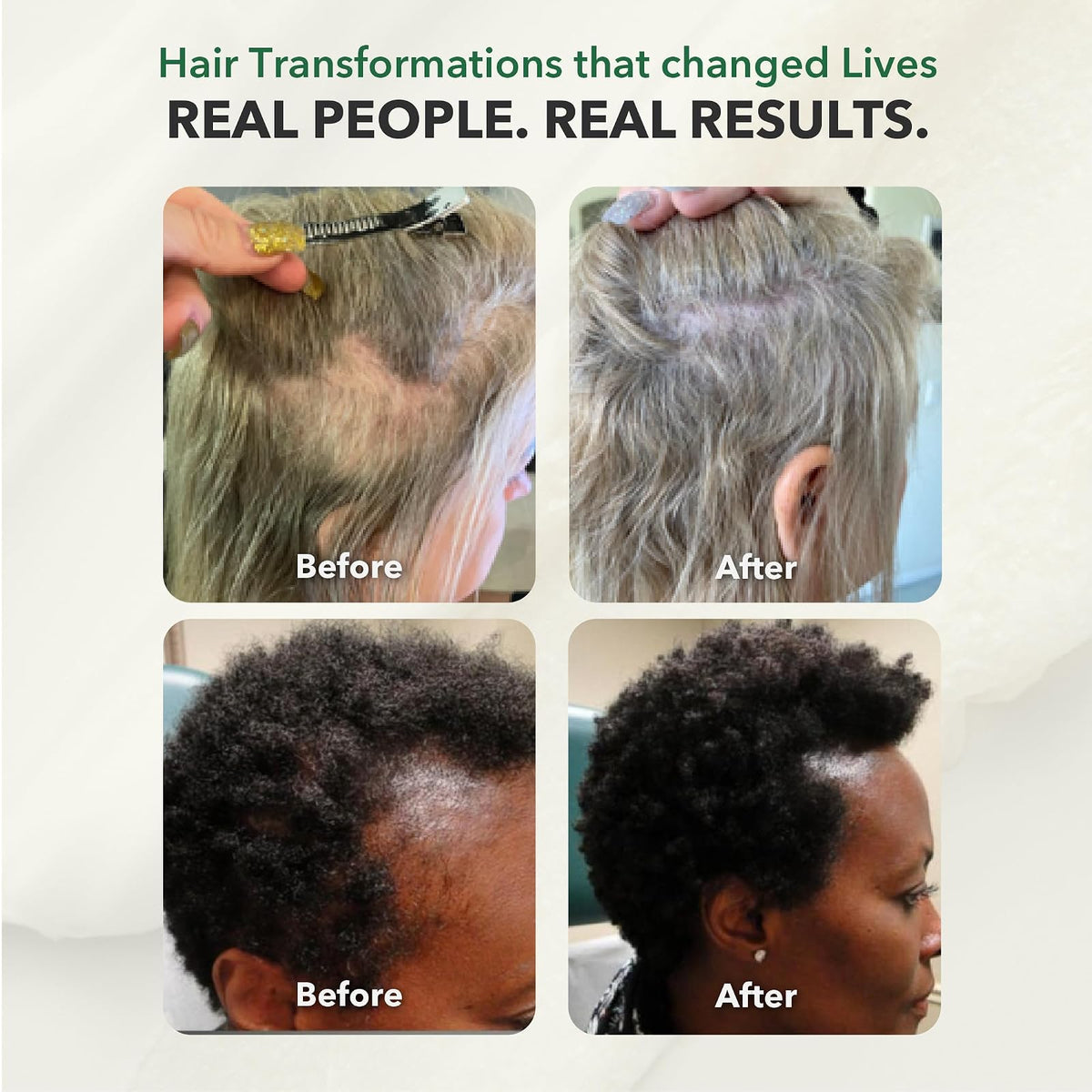 DHT reduction for thicker hair