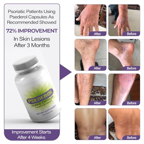 effective supplements for psoriasis symptoms