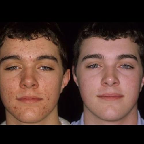 effective vitamins for acne-prone skin