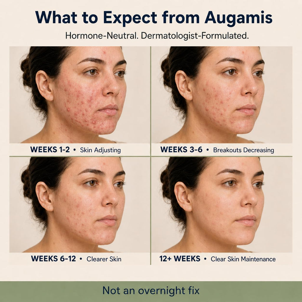 hormonal acne treatment supplement