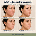 hormonal acne treatment supplement