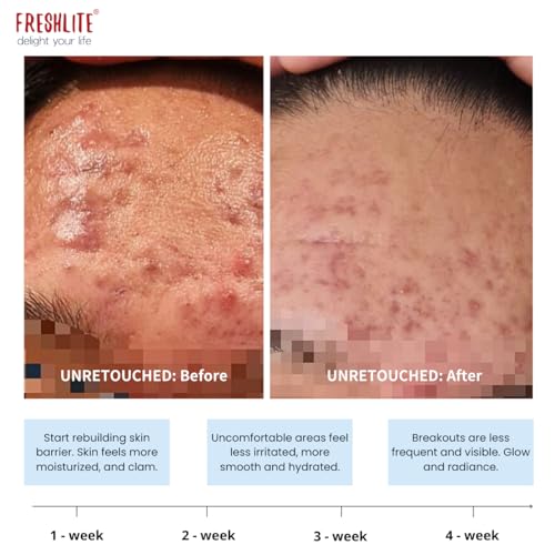 Japanese clear skin ceramide benefits