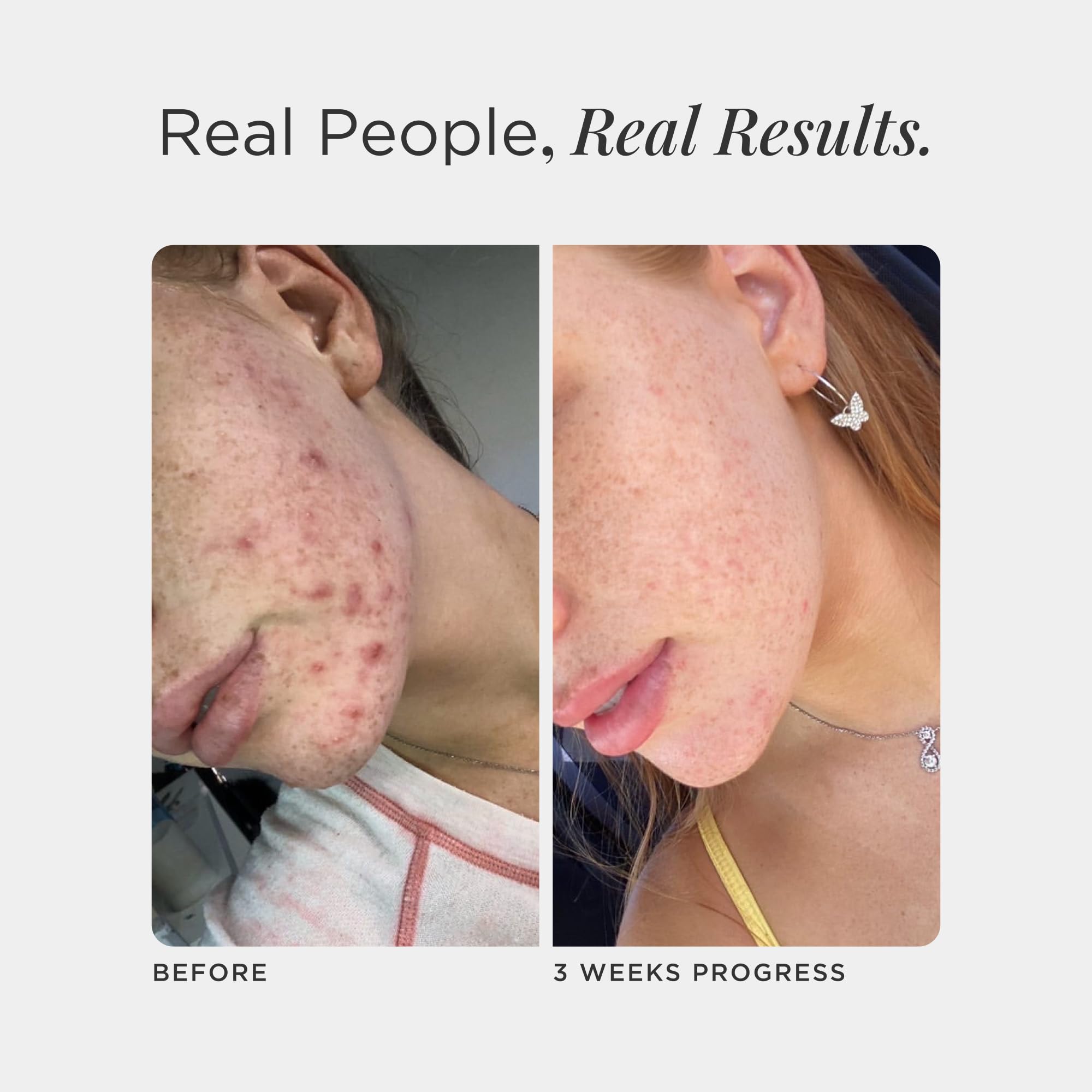 JSHealth vitamins for acne-prone skin