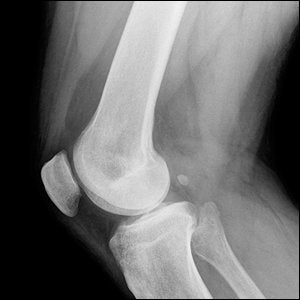 Lindberg capsules for healthy joints