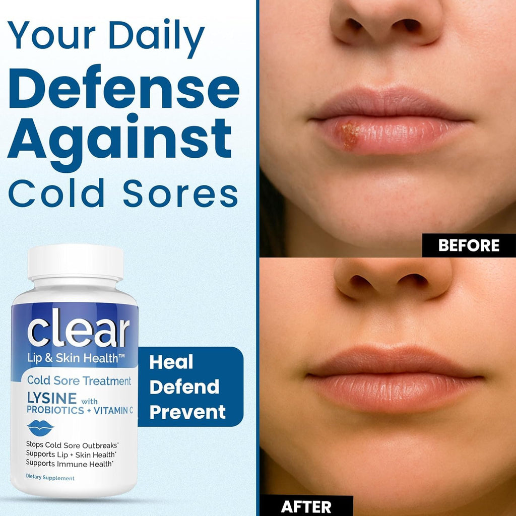 Lysine capsules for cold sore prevention