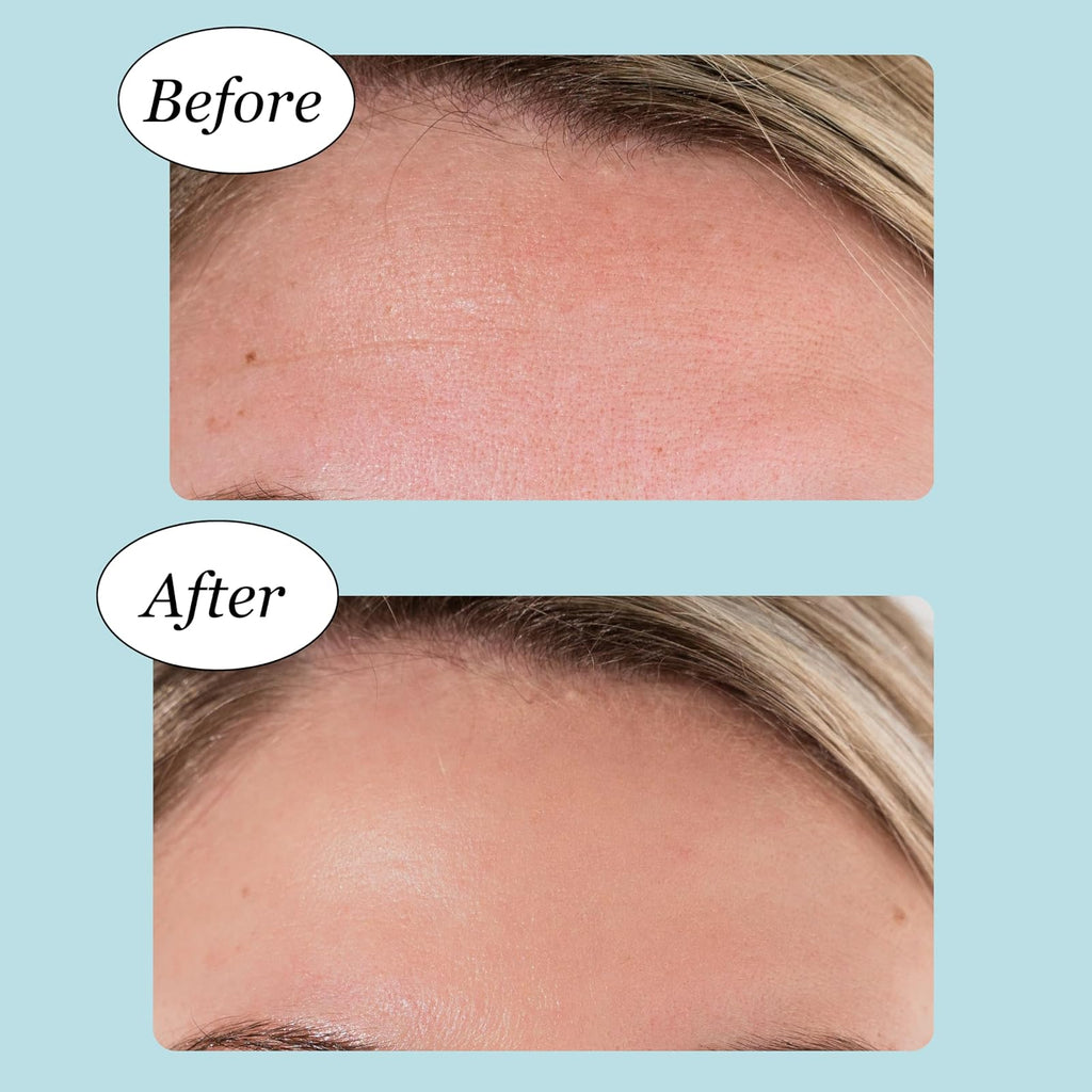 marine collagen forehead treatment