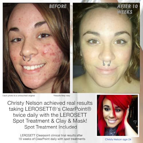 mineral-rich supplements for acne control