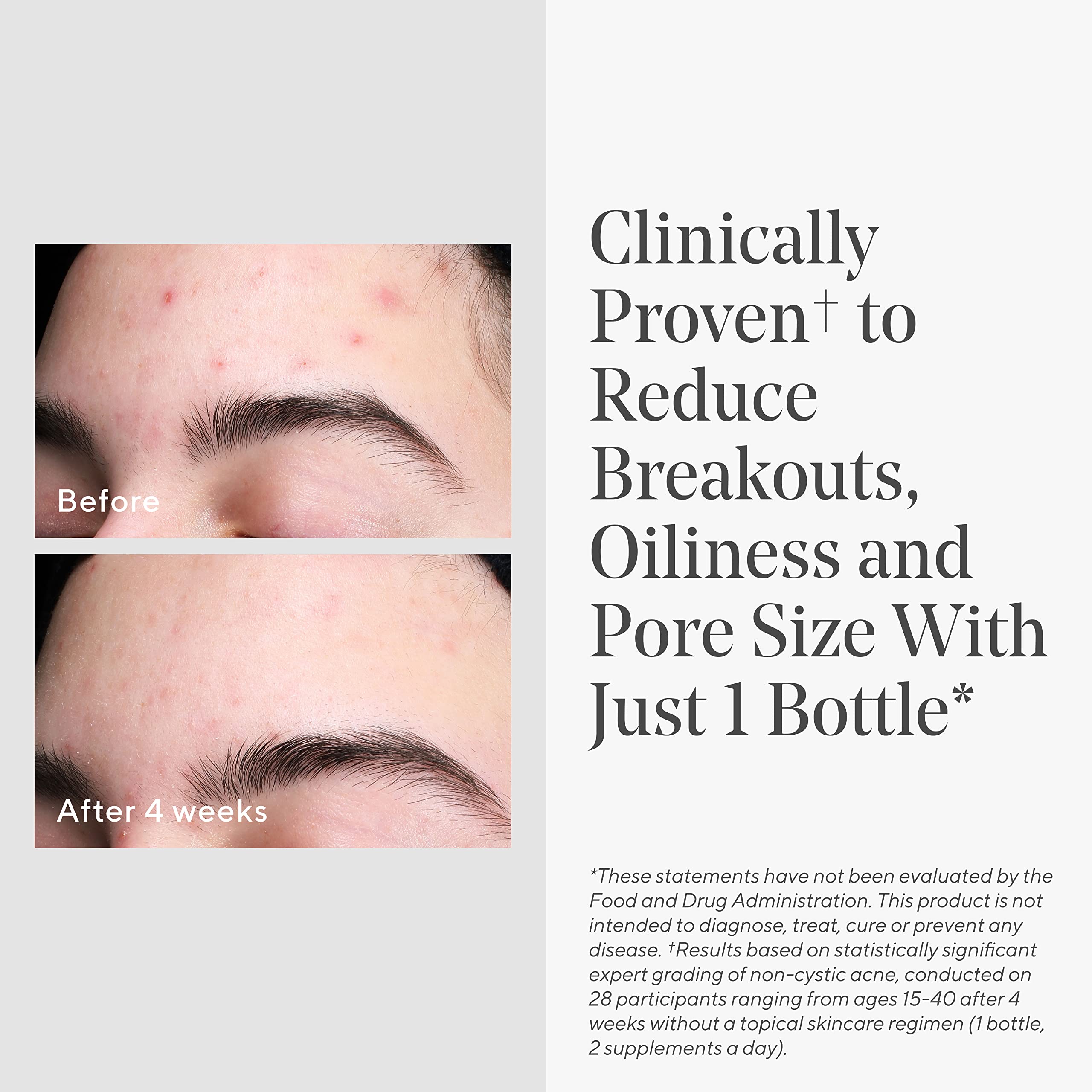 Murad Clear Skin for acne-prone individuals