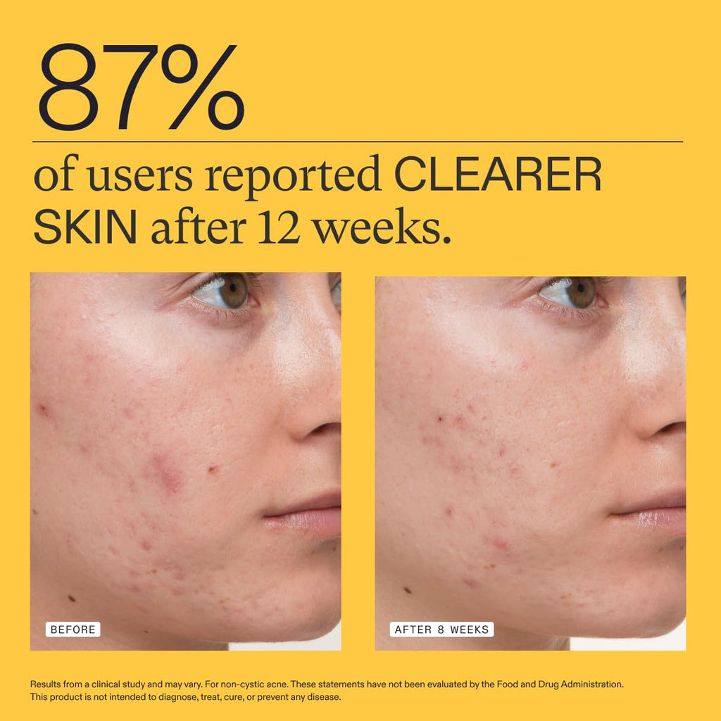 natural acne treatment for women