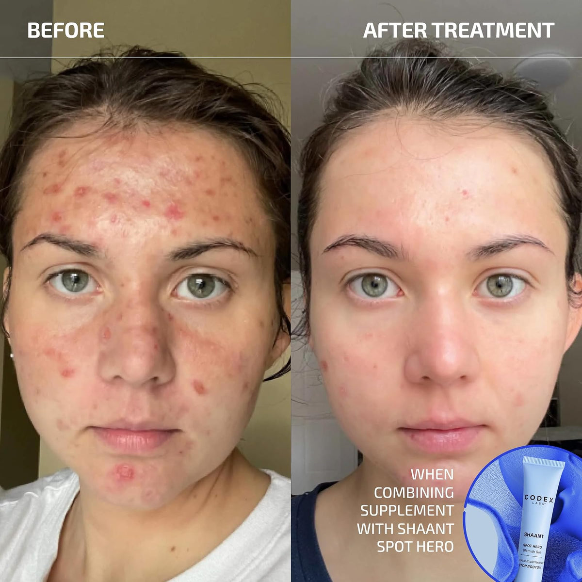 Natural probiotics for healthy skin