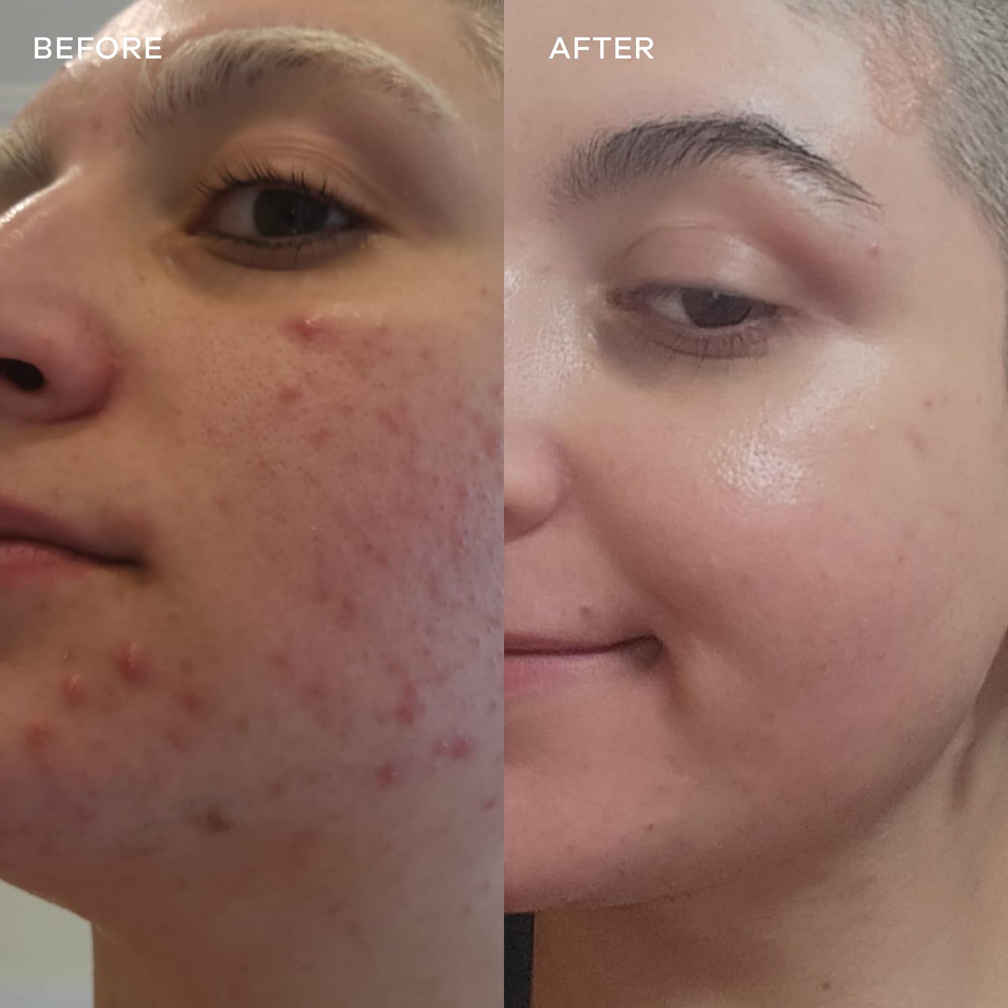 natural relief for clogged pores