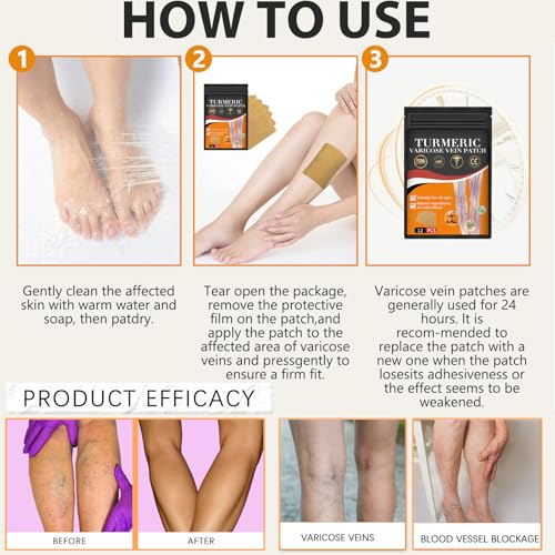 natural remedy for spider veins