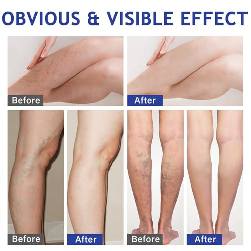 natural remedy for spider veins