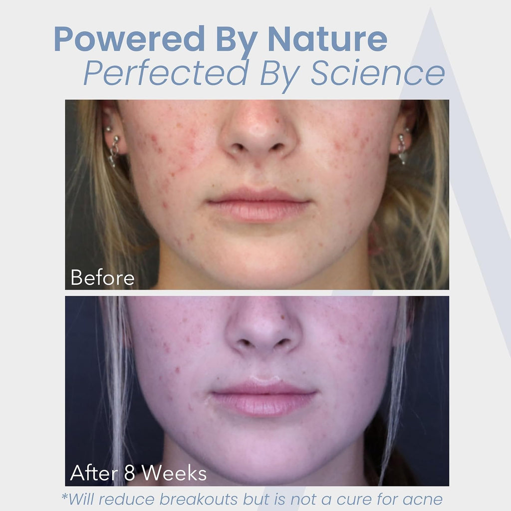 Natural solution for cystic acne
