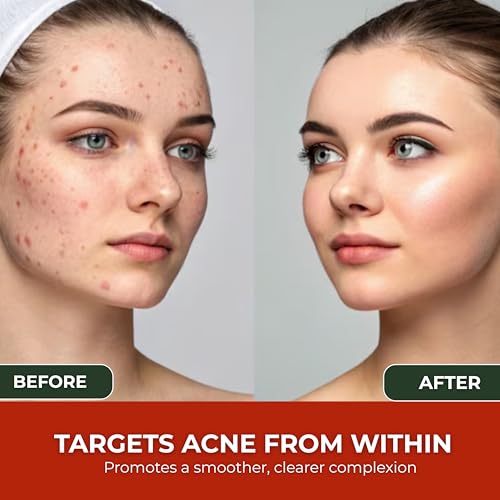 niacinamide acne treatment cream
