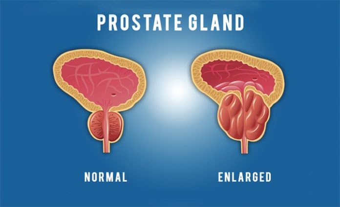pumpkin seed oil for prostate wellness