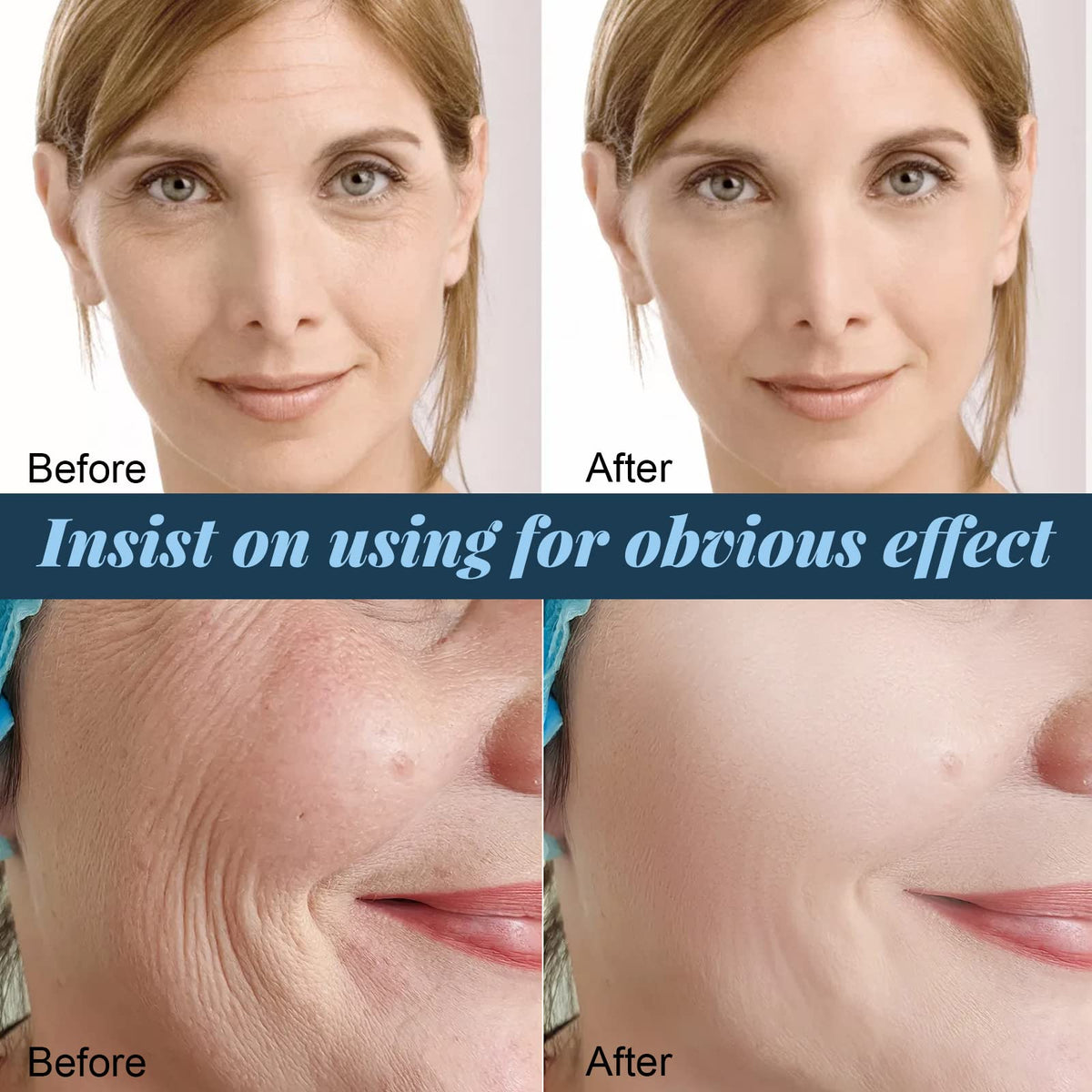 rejuvenate skin with thread lift