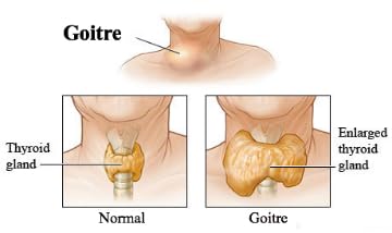 support for nodules and goiters